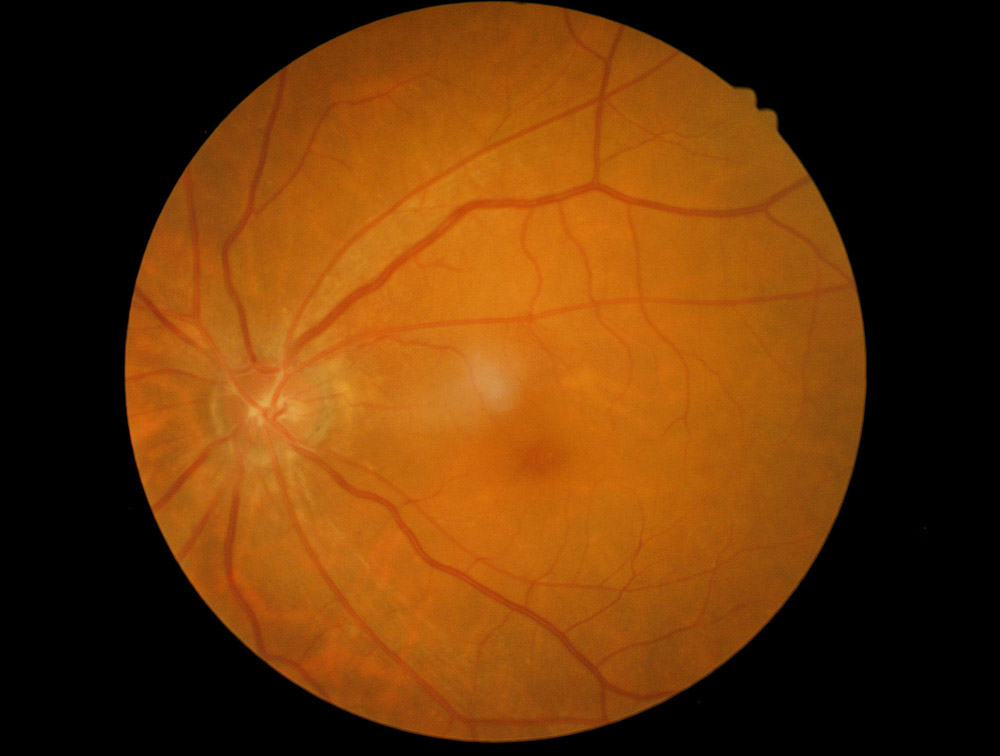 Diabetic Retinopathy | Optometrist in Northern San Antonio, TX
